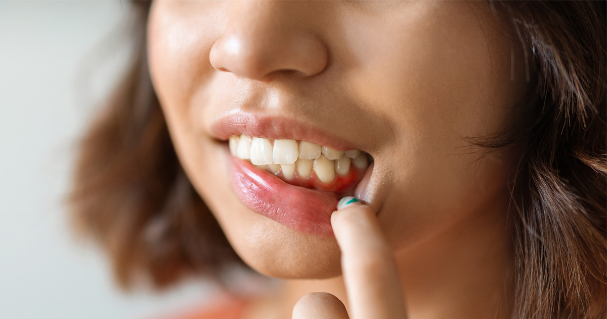 Gengivite: quais são as principais causas e tratamento 2024