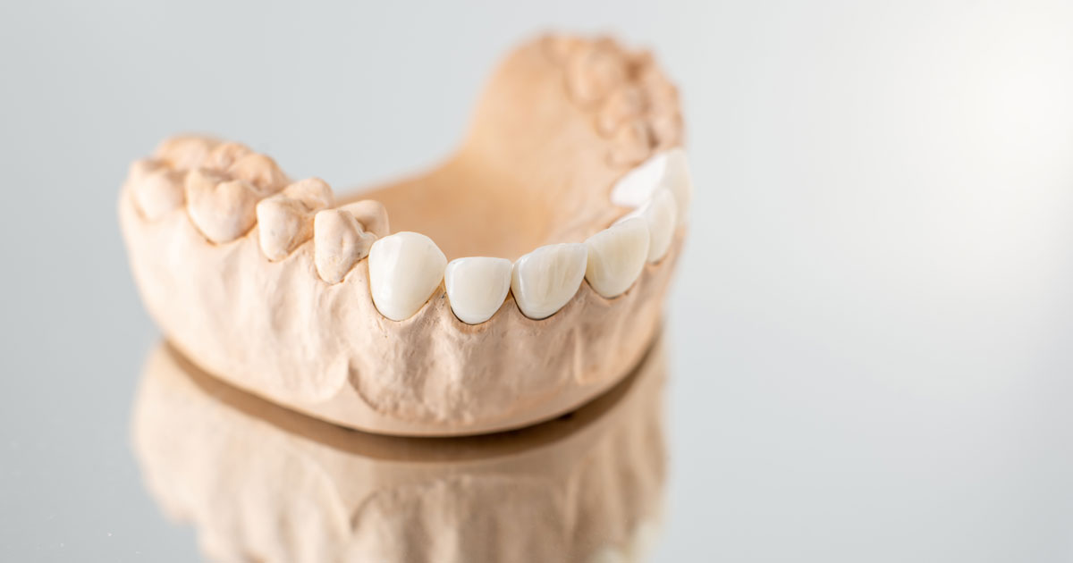 Prótese Fixa (Ponte): O Que É, Tipos, Cuidados e Duração 25